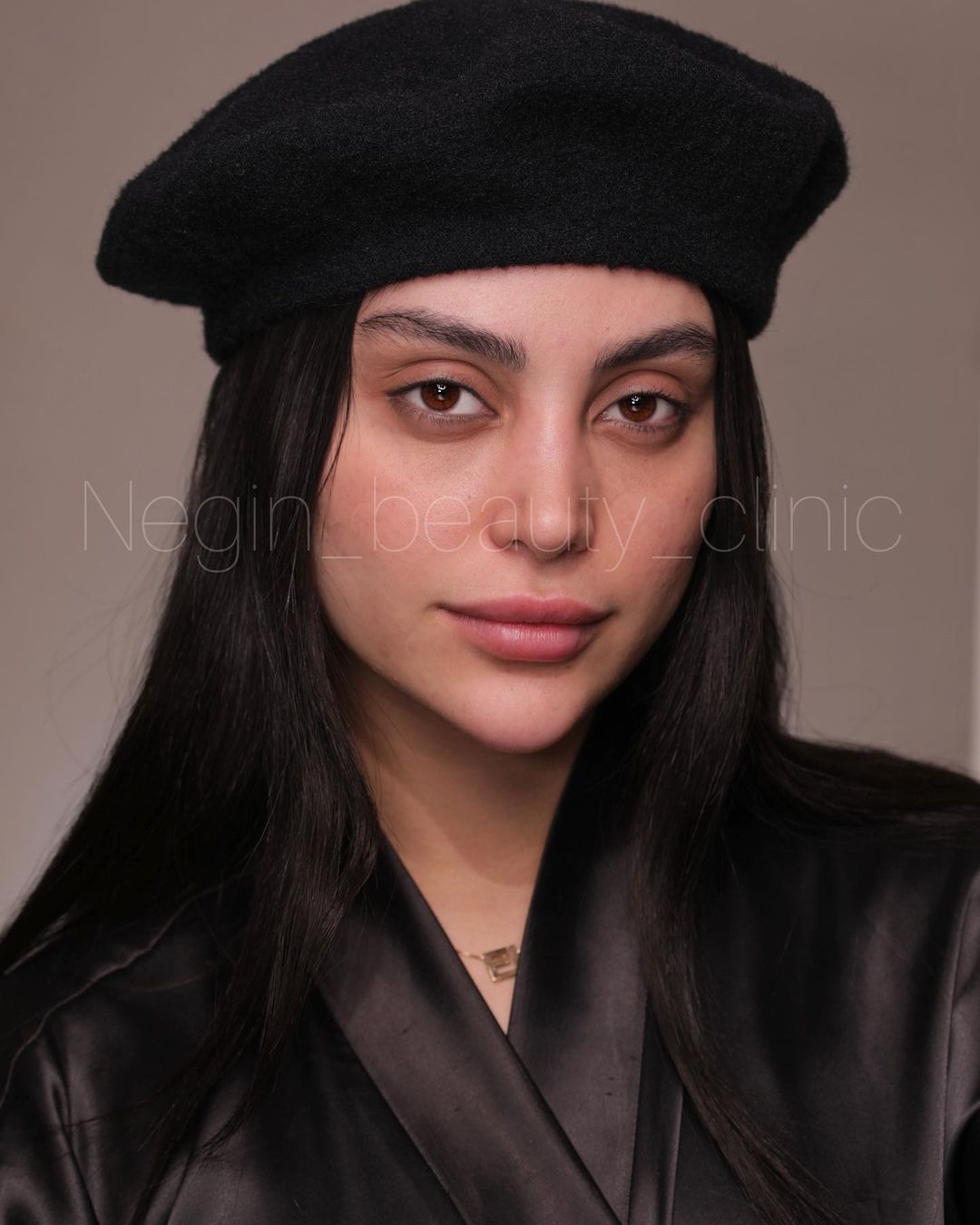 negin_beauty_clinic@instagram on Pinno: فرم دهی چانه و لب به سبک طبیعی ️ ️ فرم...