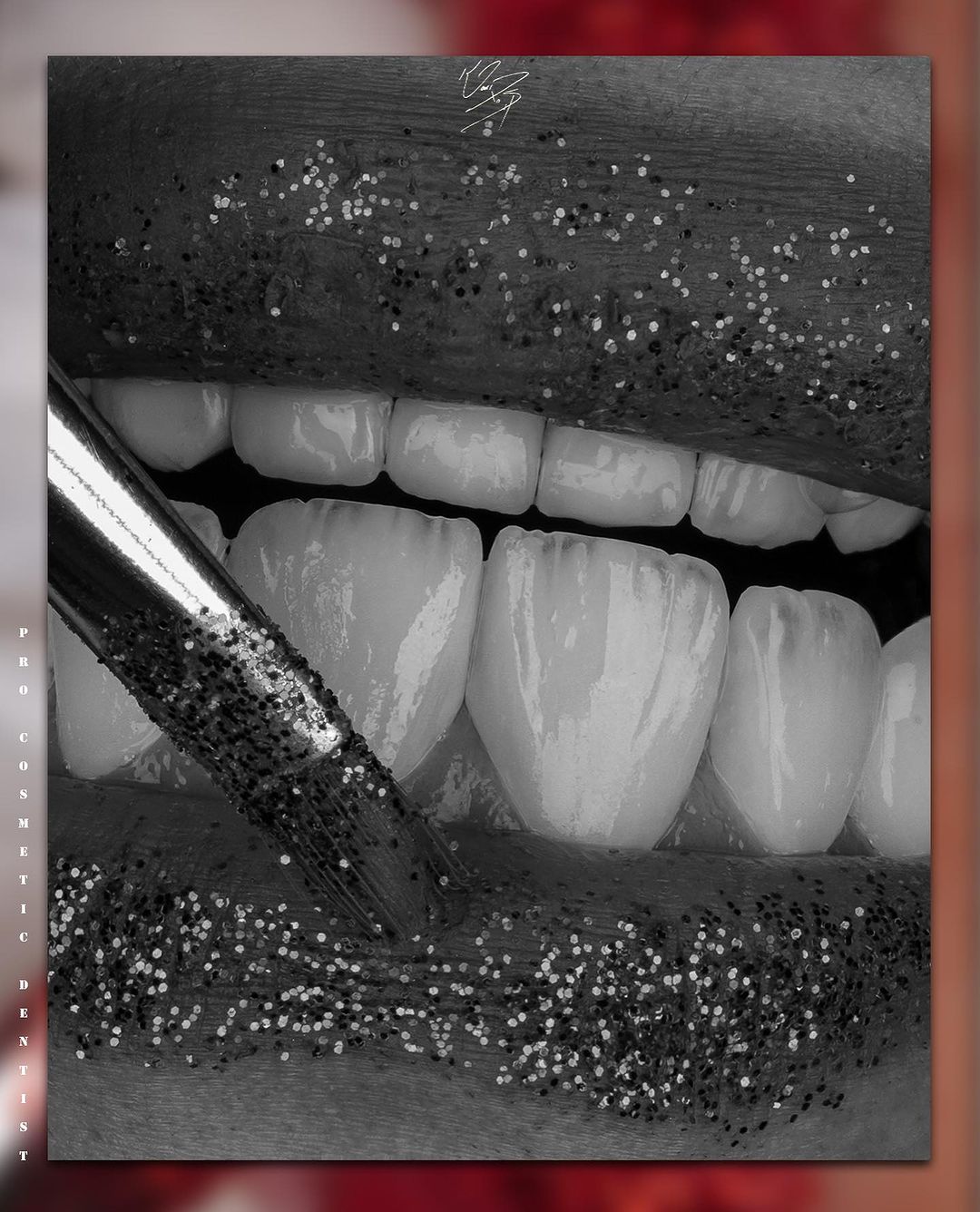 dr.koorosh.vakili@instagram on Pinno: • LAMINATE BL1 color with halo ...