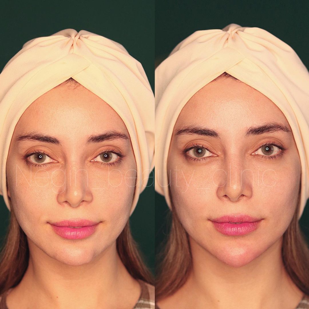 negin_beauty_clinic@instagram on Pinno: اصلاح دفرمیتی ایجاد شده در چانه توسط کلی...