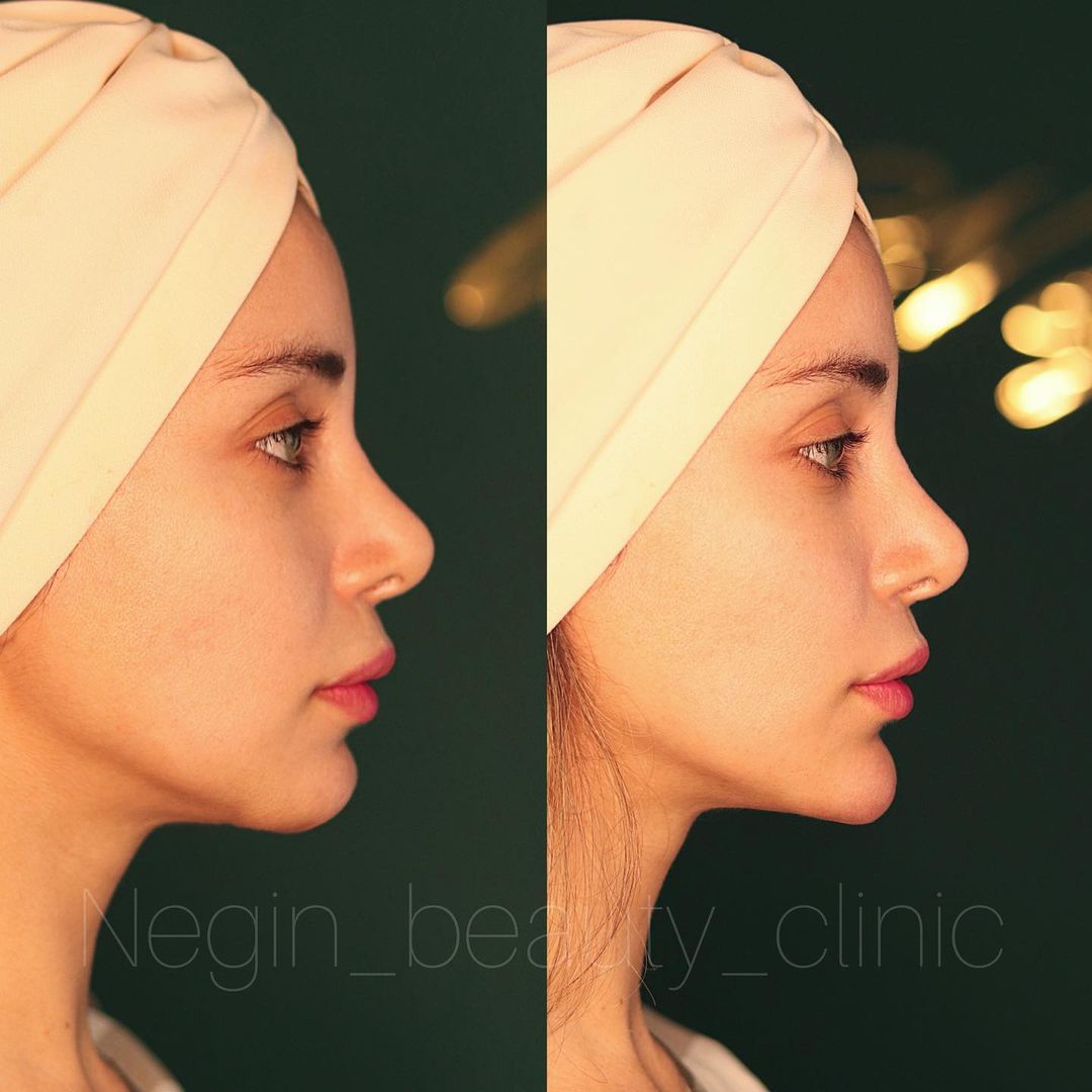negin_beauty_clinic@instagram on Pinno: اصلاح دفرمیتی ایجاد شده در چانه توسط کلی...